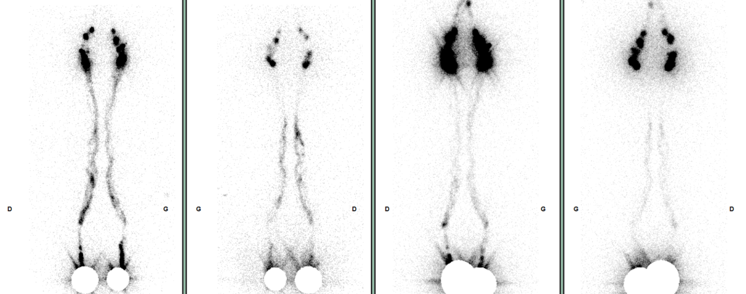 Examen Scintigraphie