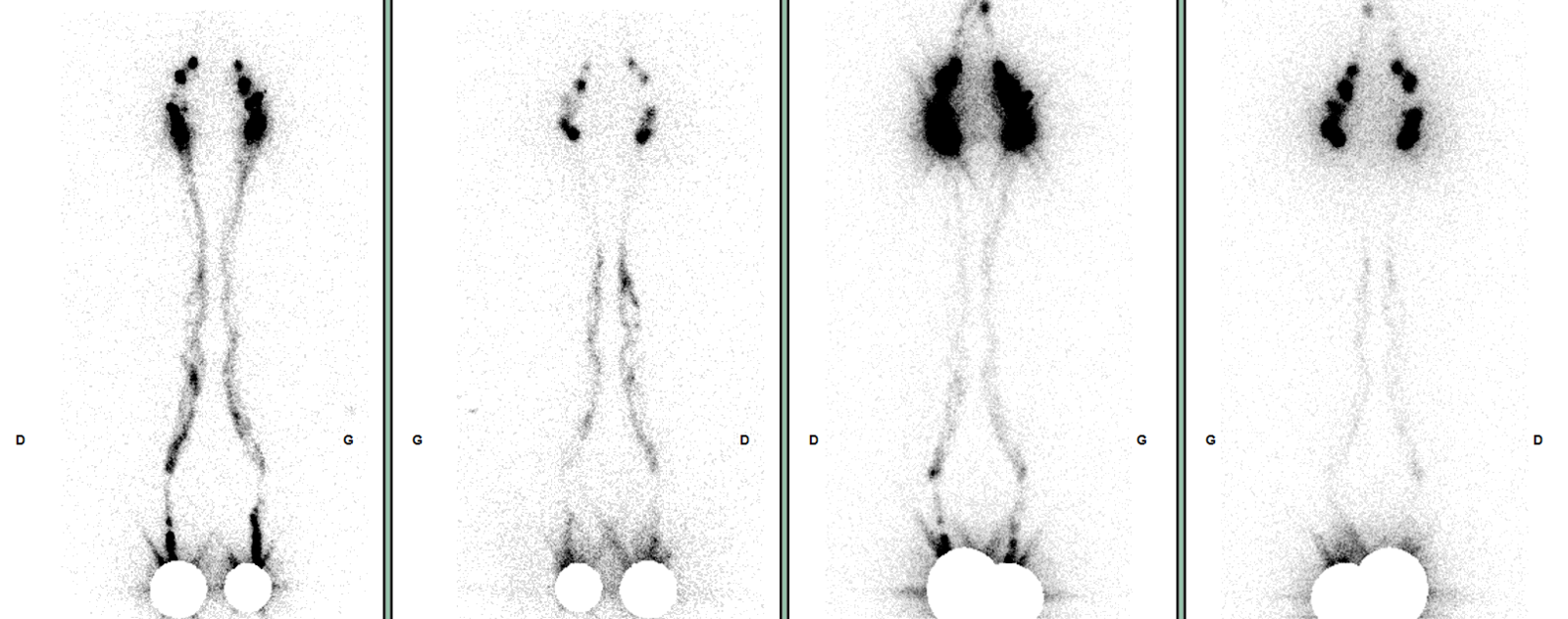 Examen Scintigraphie