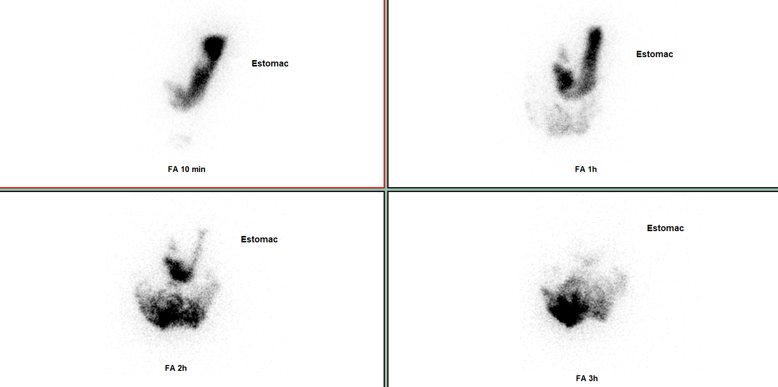 Examen Scintigraphie
